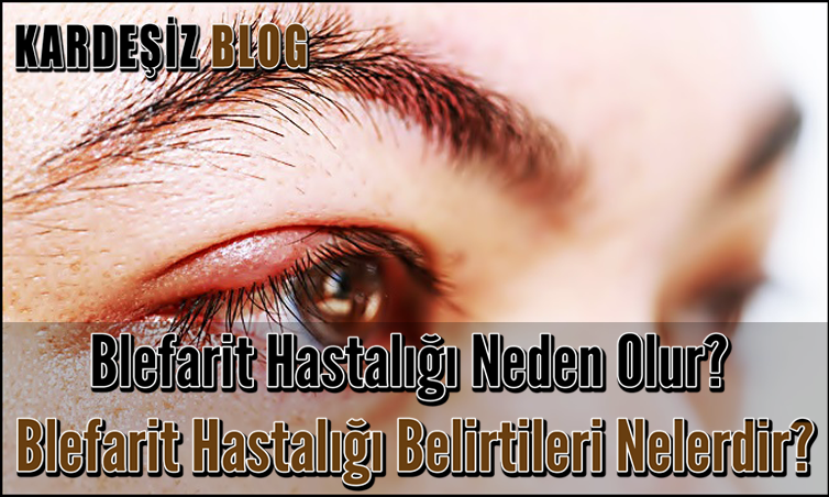Blefarit Hastalığı Neden Olur? Blefarit Hastalığı Belirtileri Nelerdir?