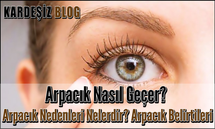 Arpacık Nasıl Geçer? Arpacık Nedenleri Nelerdir? Arpacık Belirtileri