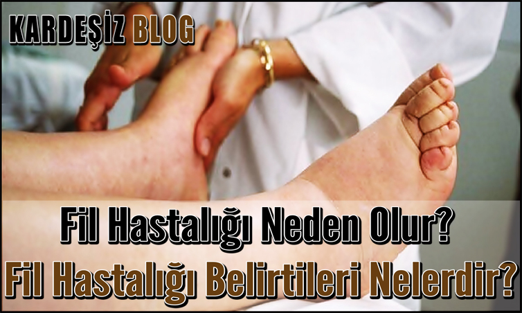 Fil Hastalığı Neden Olur? Fil Hastalığı Belirtileri Nelerdir?