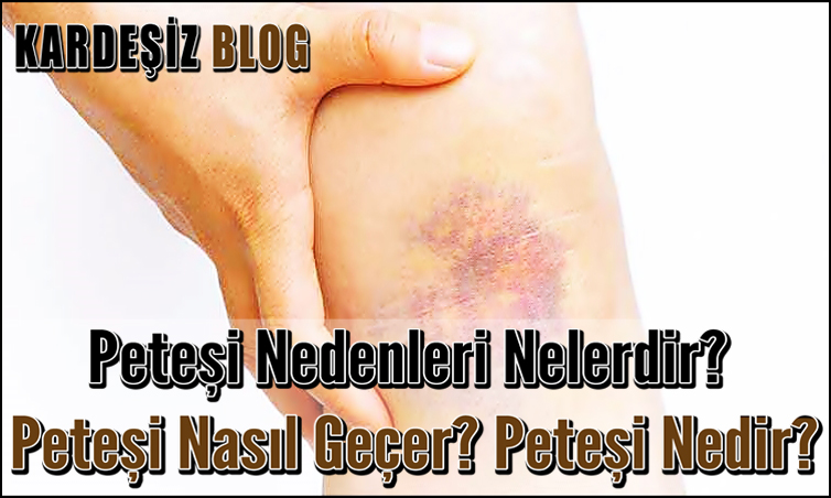Peteşi Nedenleri Nelerdir? Peteşi Nasıl Geçer? Peteşi Nedir?
