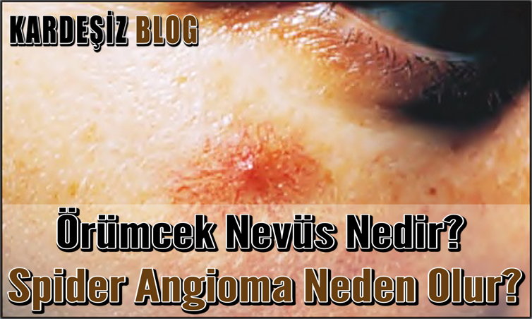 Örümcek Nevüs Nedir? Spider Angioma Neden Olur?
