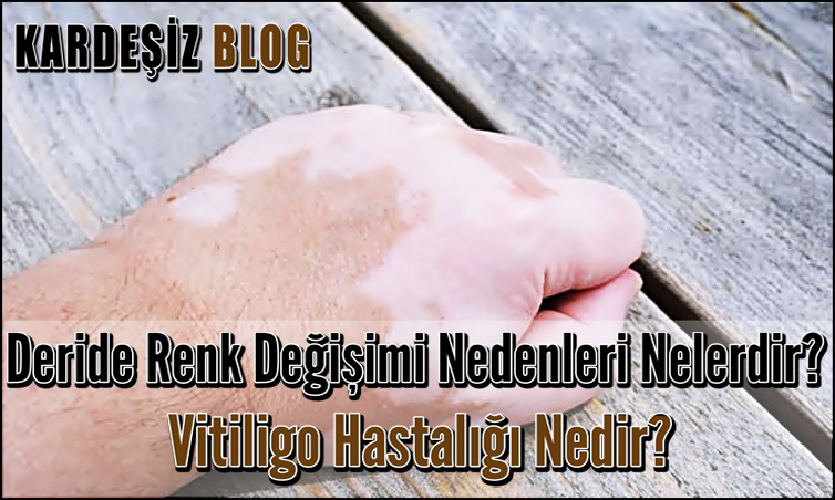 Deride Renk Değişimi Nedenleri Nelerdir? Vitiligo Hastalığı Nedir?