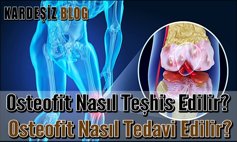 Osteofit Nasıl Teşhis Edilir? Osteofit Nasıl Tedavi Edilir?